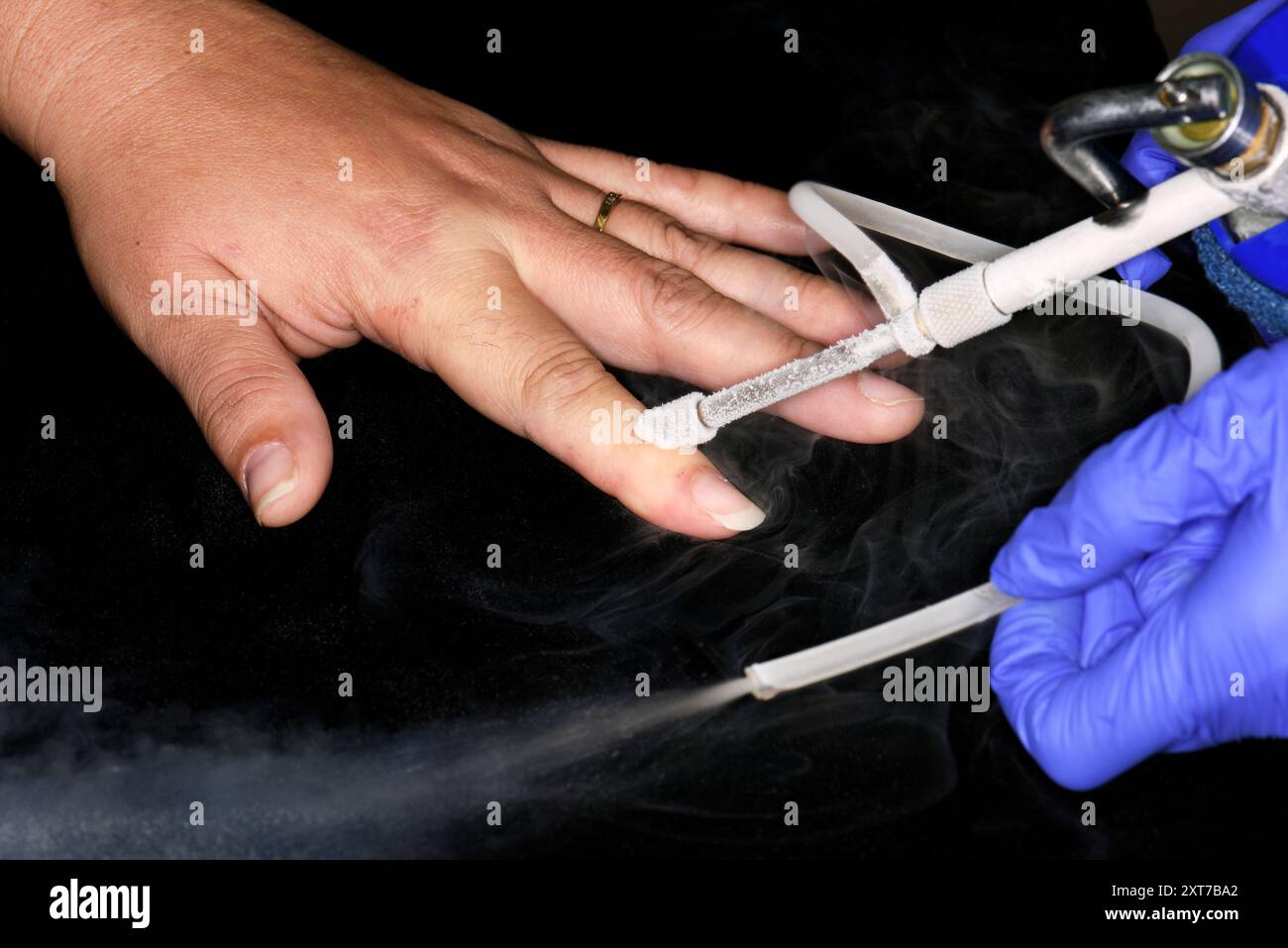 Patient being treated with cryotherapy for pyogenic granuloma. A ...