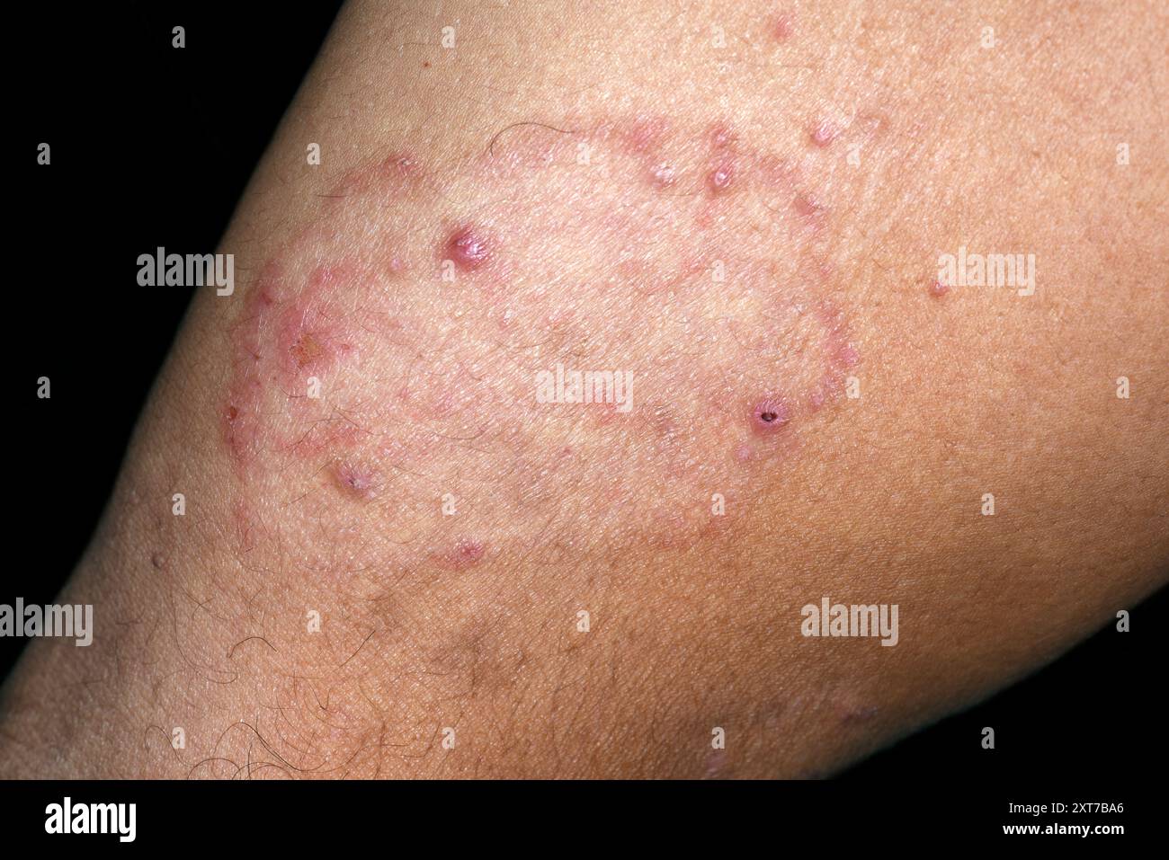 Rash on the skin of a 50 year old Hispanic male patient with Majocchi's ...
