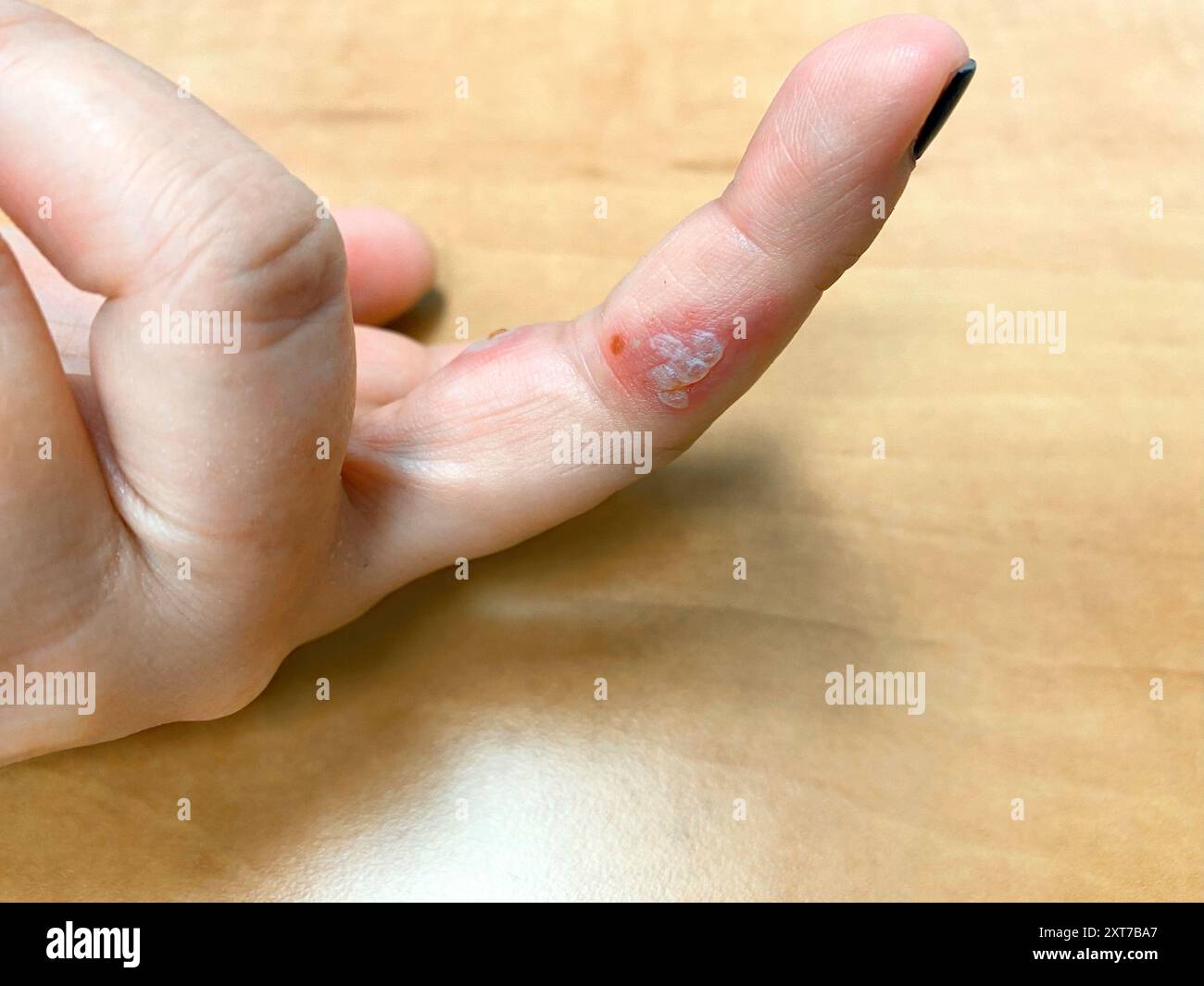 Blistering caused by a recurrent herpes simplex virus (HSV) infection ...