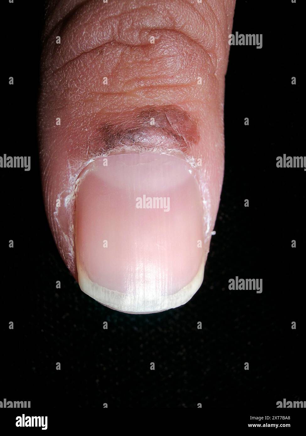Bowen's disease on the nail fold of a 35 year old Hispanic female ...
