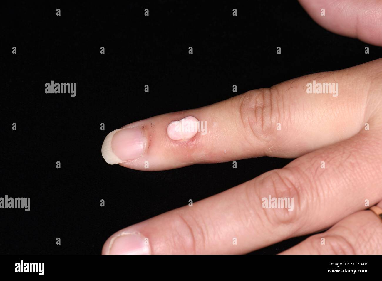 Pyogenic granuloma on the finger of a patient that has been treated ...