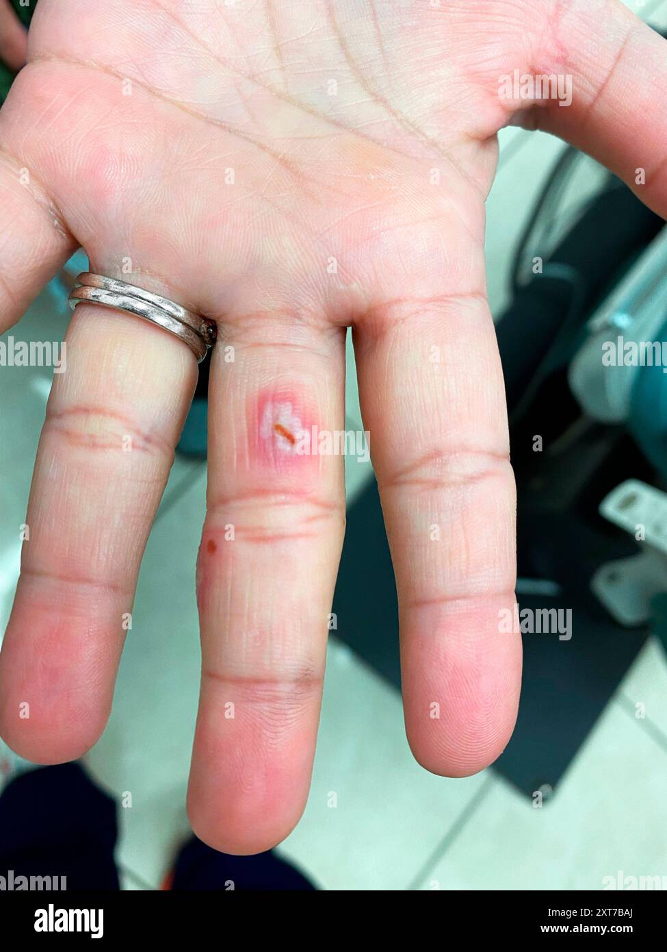 Blistering caused by a recurrent herpes simplex virus (HSV) infection ...