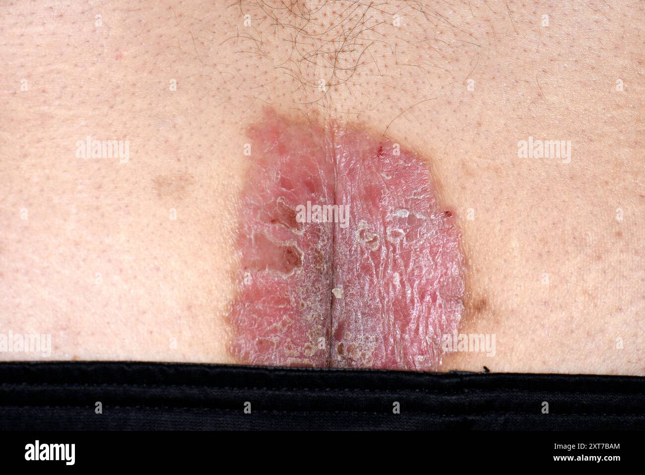 Psoriasis On The Intergluteal Cleft Of A 56 Year Old Hispanic Male Patient Psoriasis Is A Skin