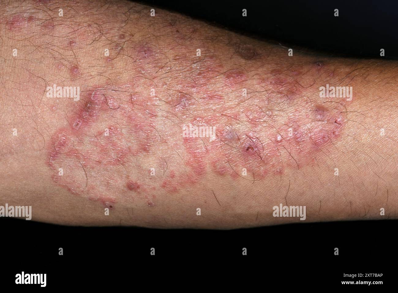 Rash on the arm of a 50 year old Hispanic male patient with Majocchi's ...