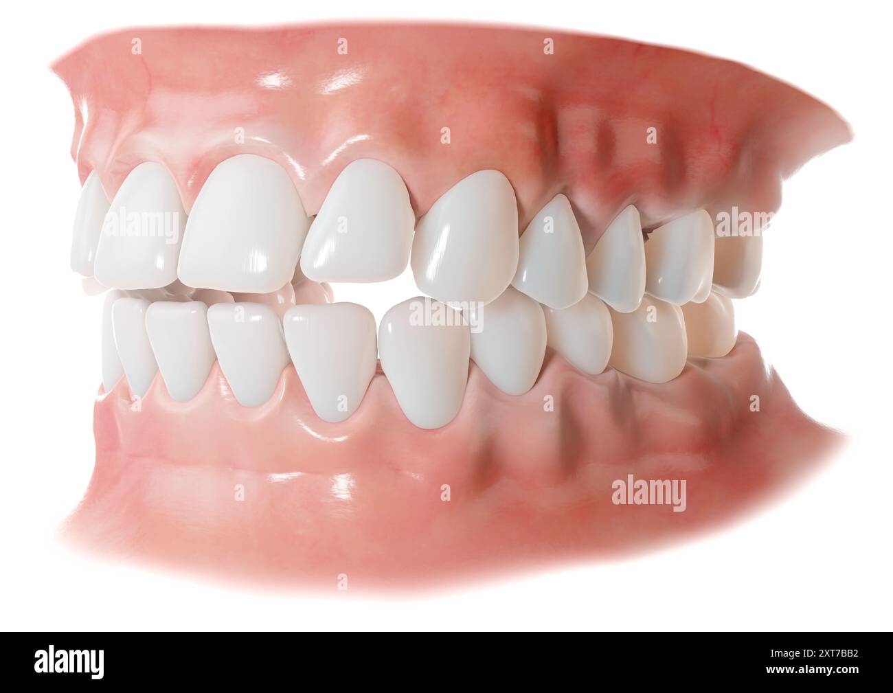 Illustration of a malocclusion with an open bite. In this malocclusion ...