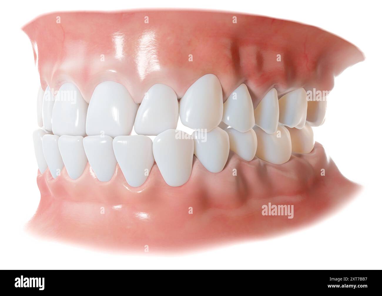 Illustration of a prognathism, a protrusion of the lower jaw. In this ...