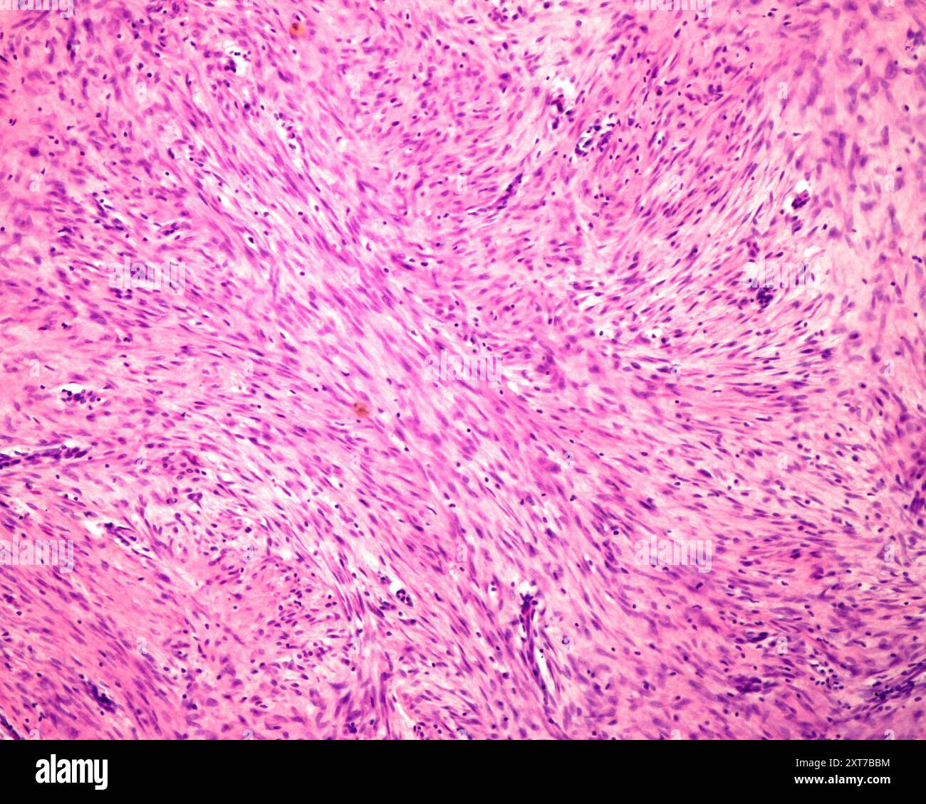 Muscle fibrosarcoma, light micrograph. Fibrosarcoma (fibroblastic ...