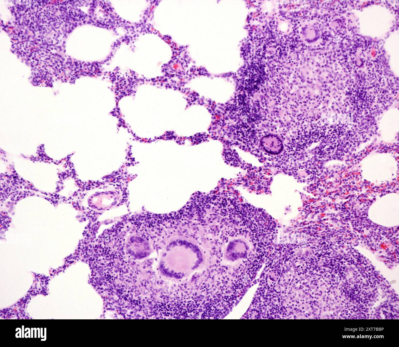 Light micrograph showing several Langhans cells in a human lung ...