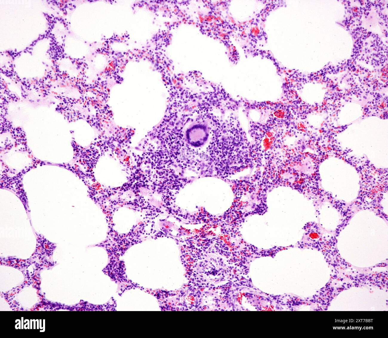 Light micrograph showing a Langhans cell in a human lung affected by ...