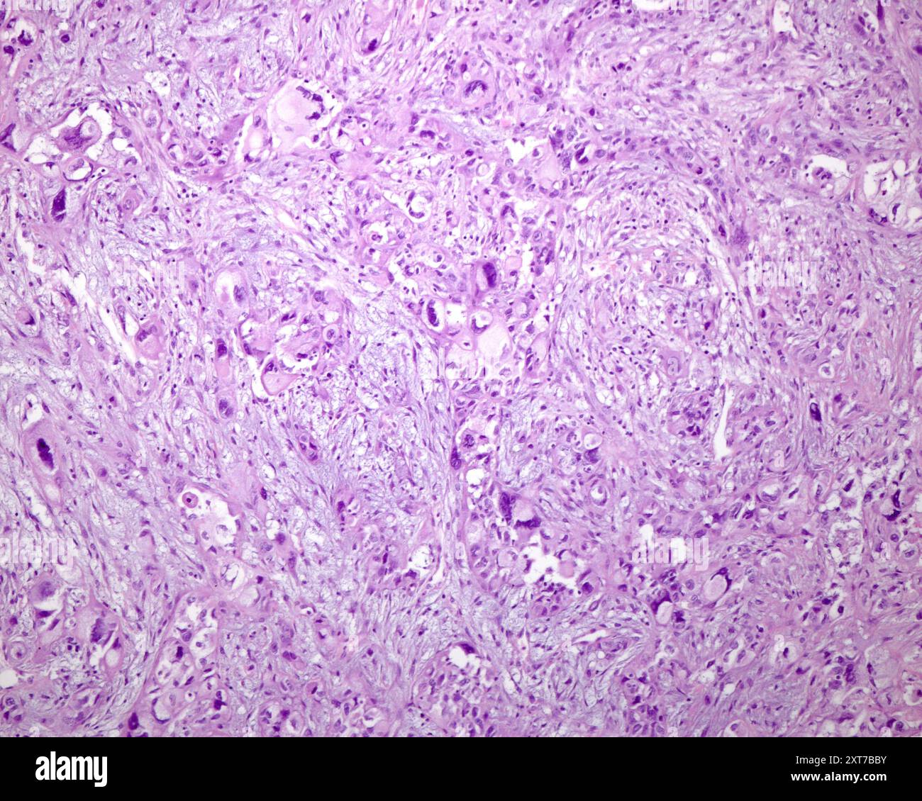 Osteosarcoma, light micrograph. Osteosarcoma is the most common primary ...