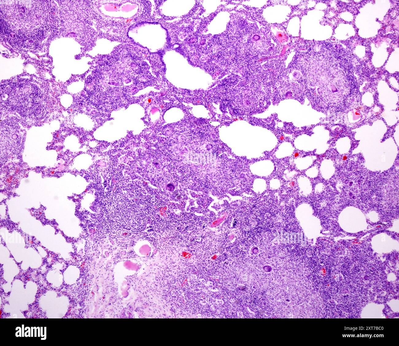 Light micrograph showing a human lung with a severe tuberculosis ...