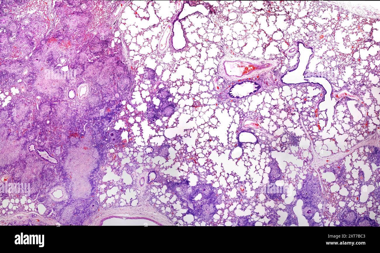 Light micrograph showing the border between a large tuberculosis lesion ...