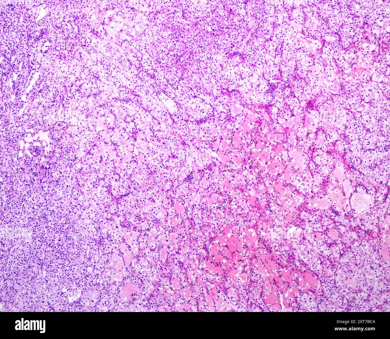 Light micrograph of a human kidney with hypernephroma, or renal cell ...