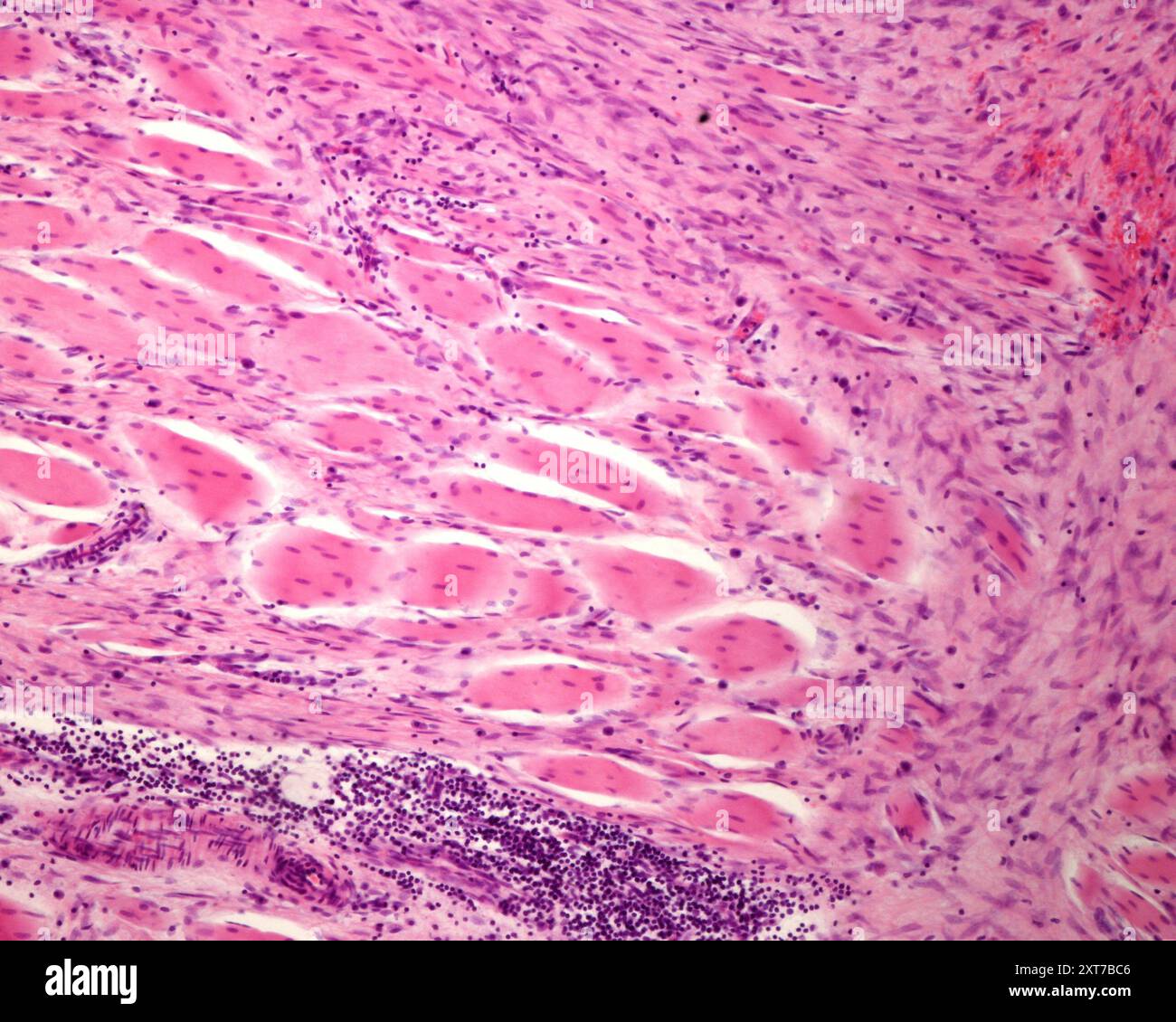 Muscle fibrosarcoma, light micrograph. Muscle fibrosarcoma is a ...