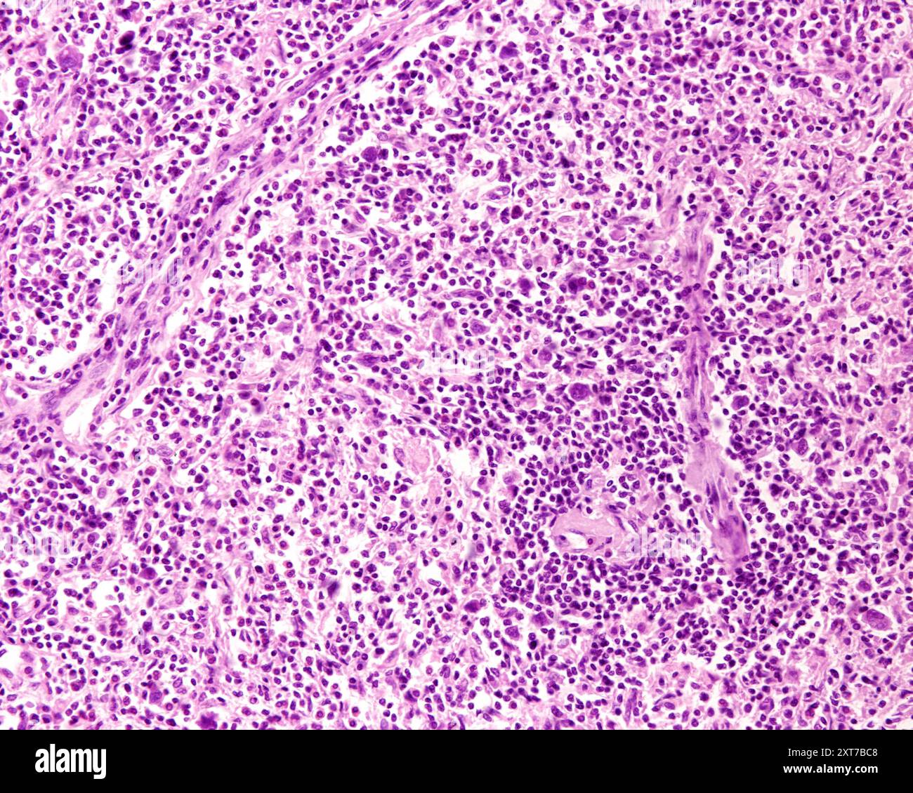 Light micrograph of a human lymph node in a patient with Hodgkin ...