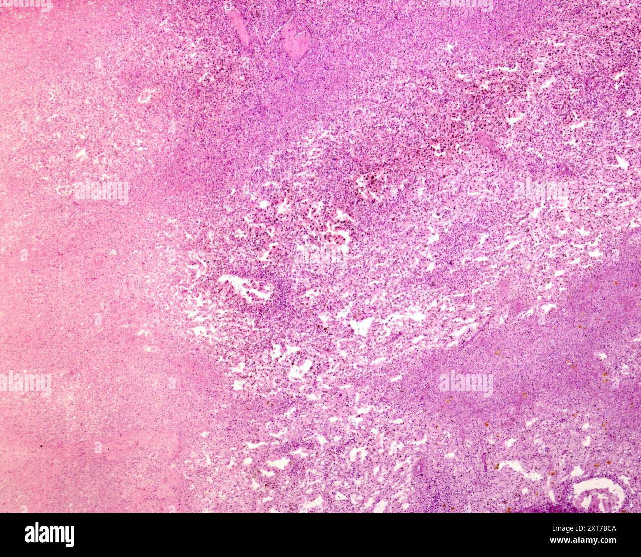 Light micrograph showing a splenic white infarct caused by an arterial ...