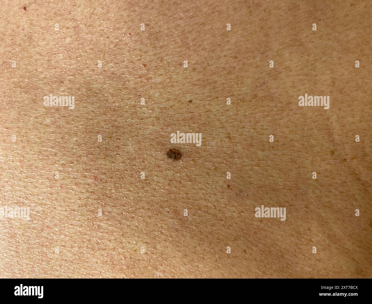 Seborrheic keratosis on a patient's back. This skin growth, also known ...