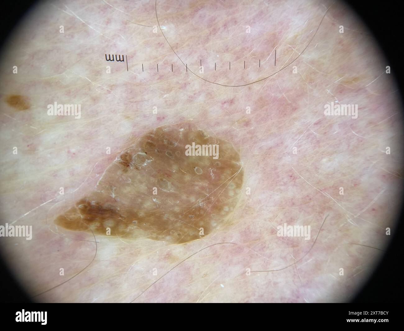 Dermatoscope image of a seborrheic keratosis on the back of a 68 year ...