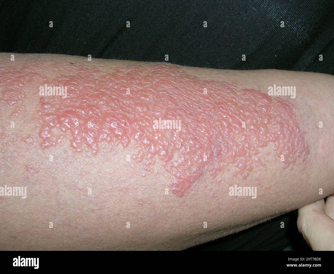 Plaques on the skin of a patient with lupus erythematosus (LE). LE is ...