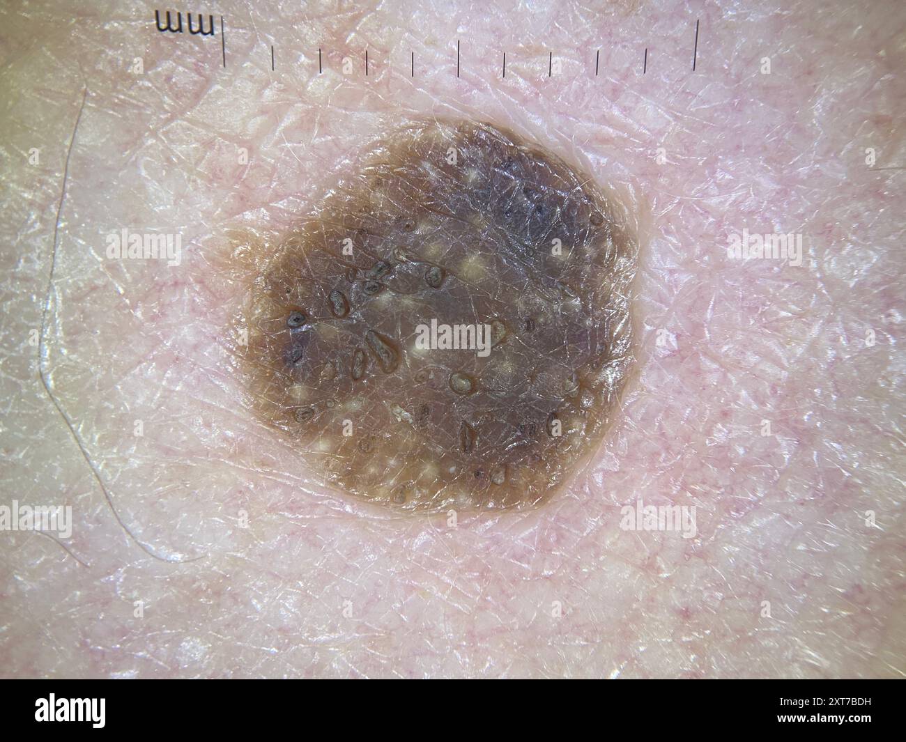 Dermatoscope image of a seborrheic keratosis on the back of a 68 year ...
