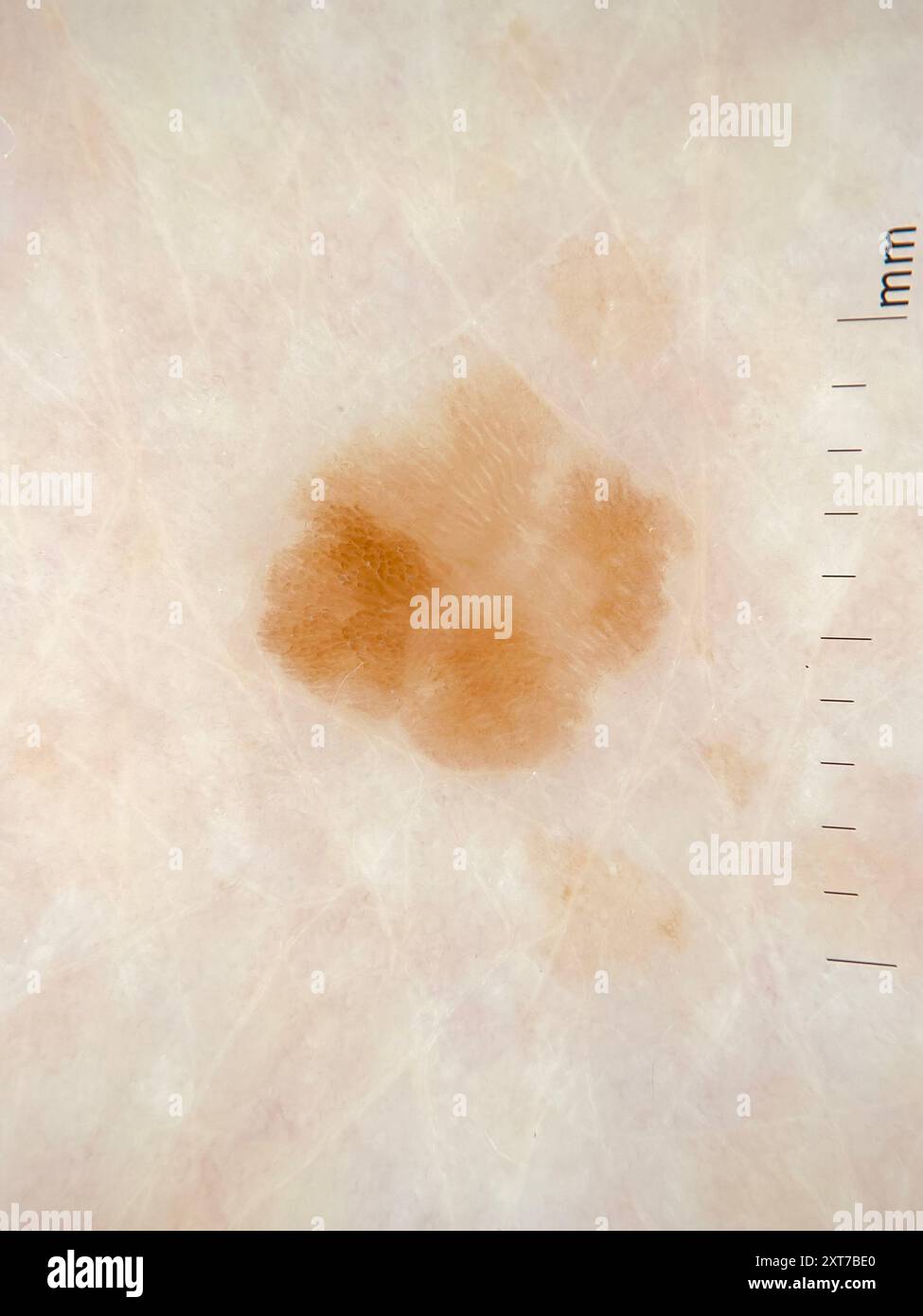 Dermatoscope image of a seborrheic keratosis on a patient's skin. This ...