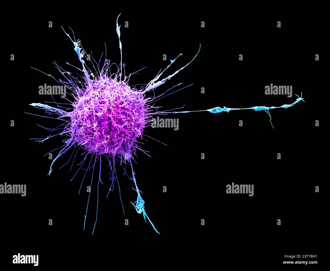 Cervical cancer cell, coloured scanning electron micrograph (SEM). The ...