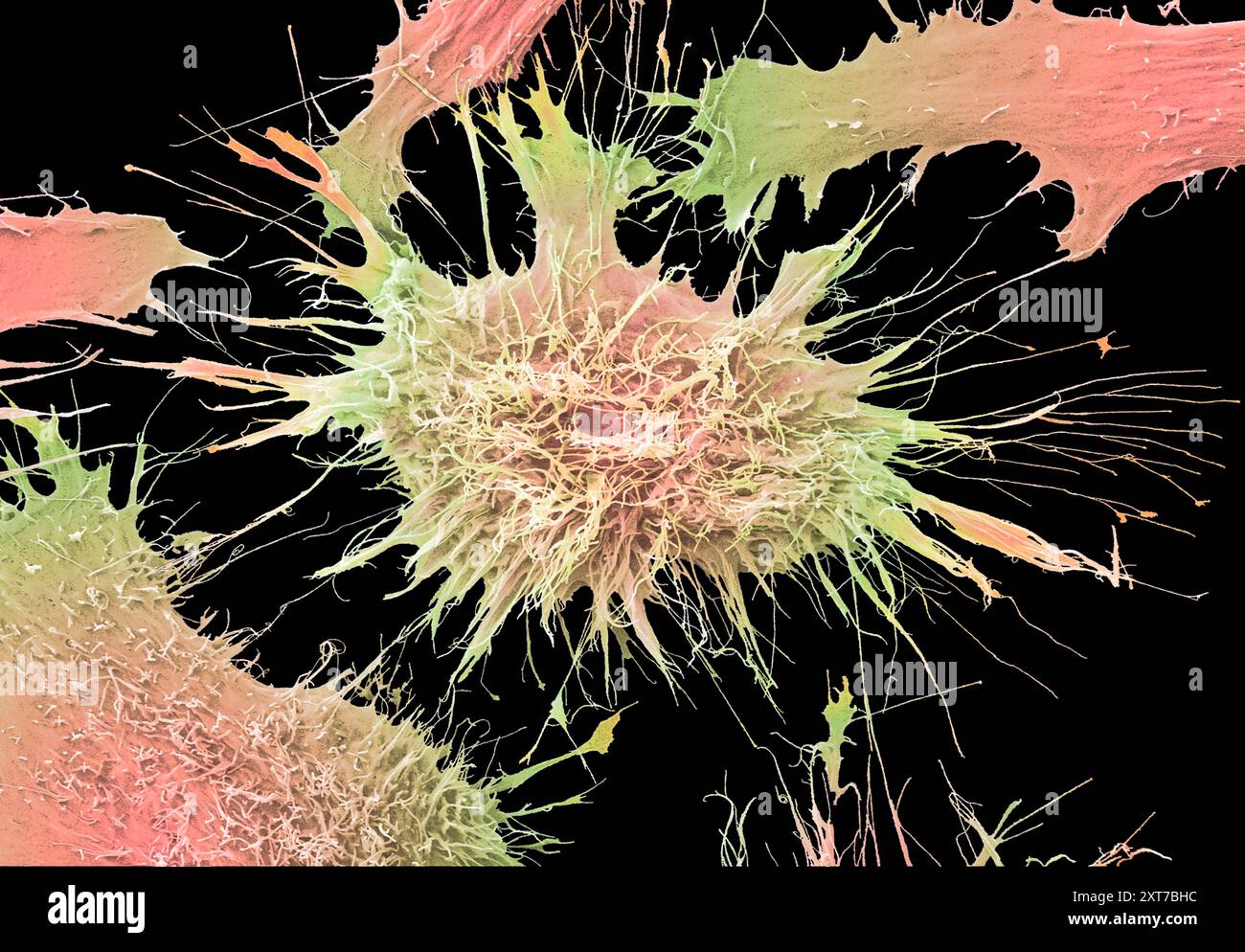 Cervical cancer cells, coloured scanning electron micrograph (SEM). The ...