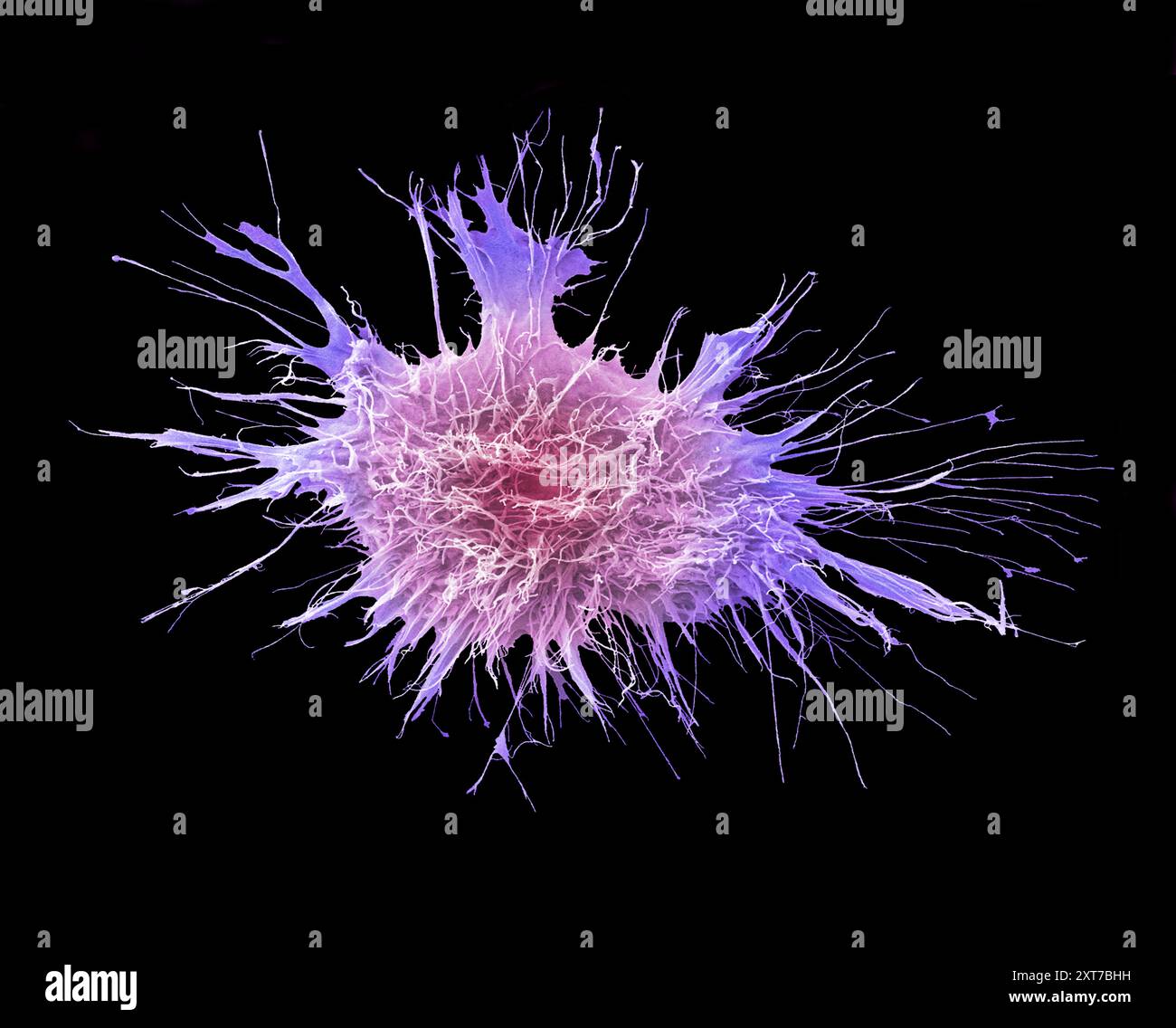 Cervical cancer cell, coloured scanning electron micrograph (SEM). The ...