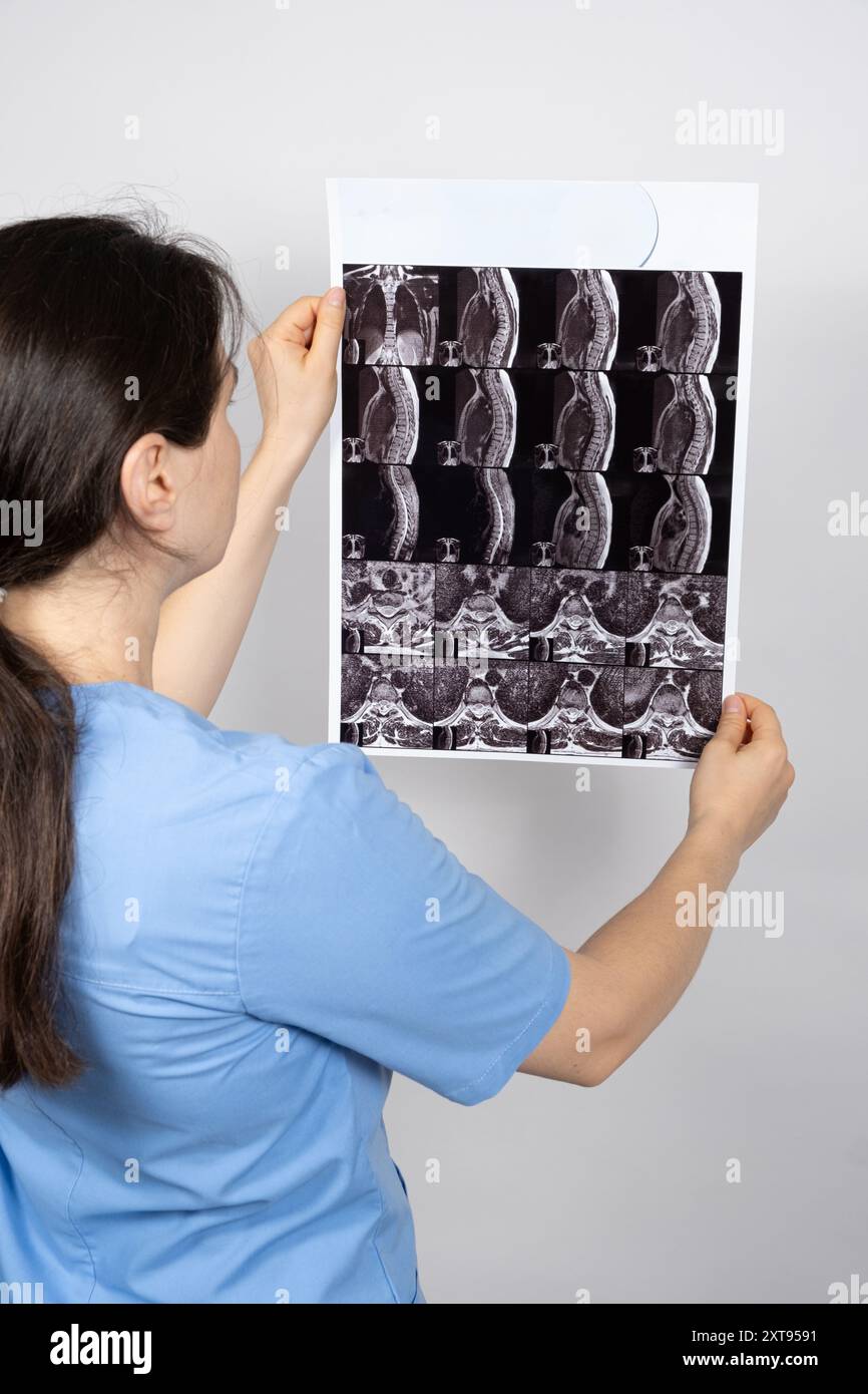 The doctor holds an MRI image of a patient with intervertebral disc ...