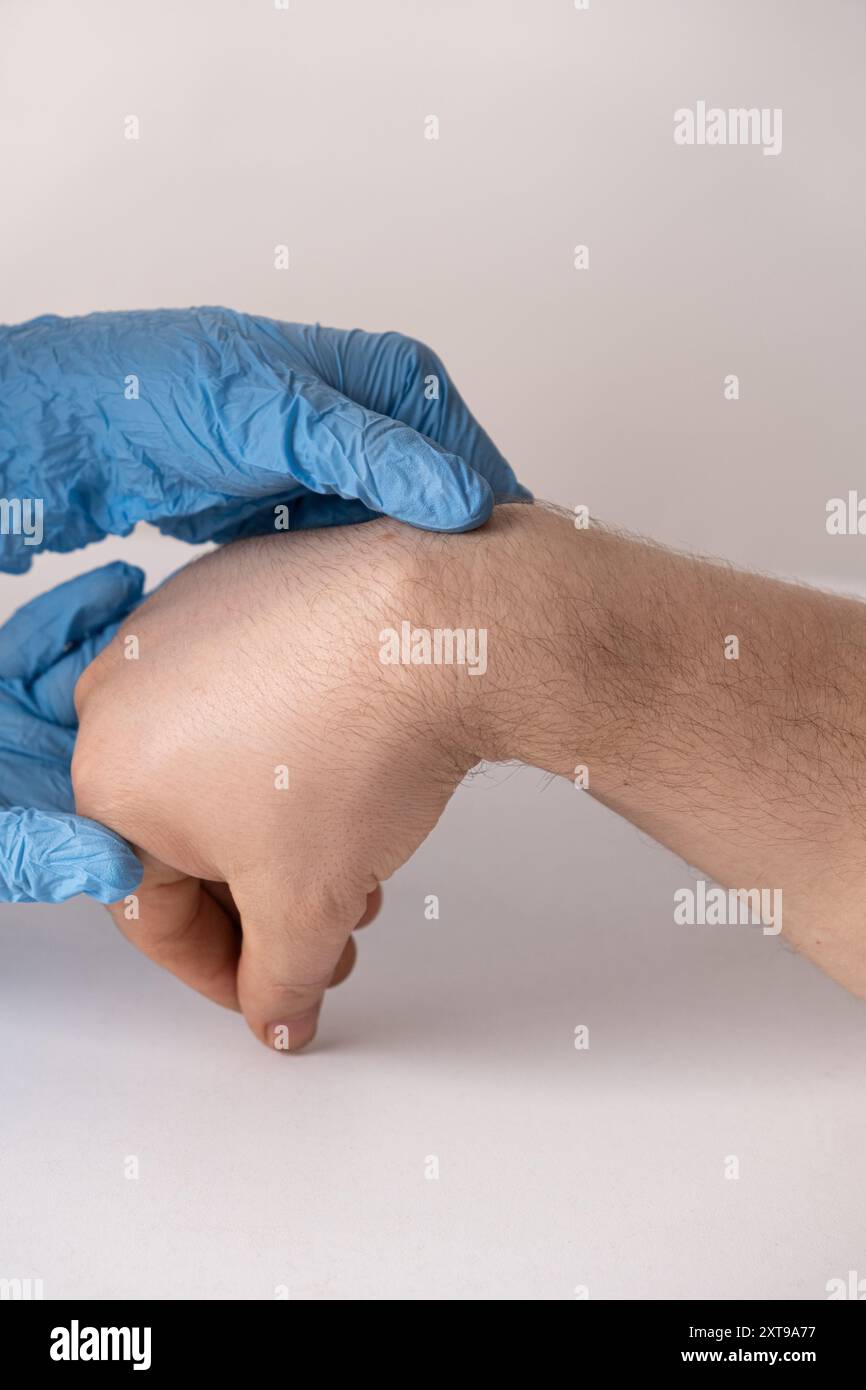 Ganglion cyst or hygroma of the wrist on the hand of a male patient ...