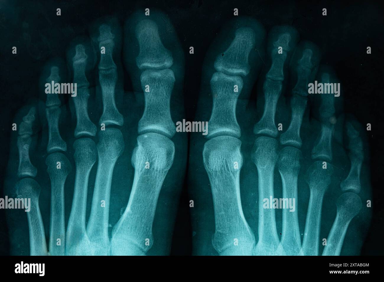 Broken toe xray hi-res stock photography and images - Alamy