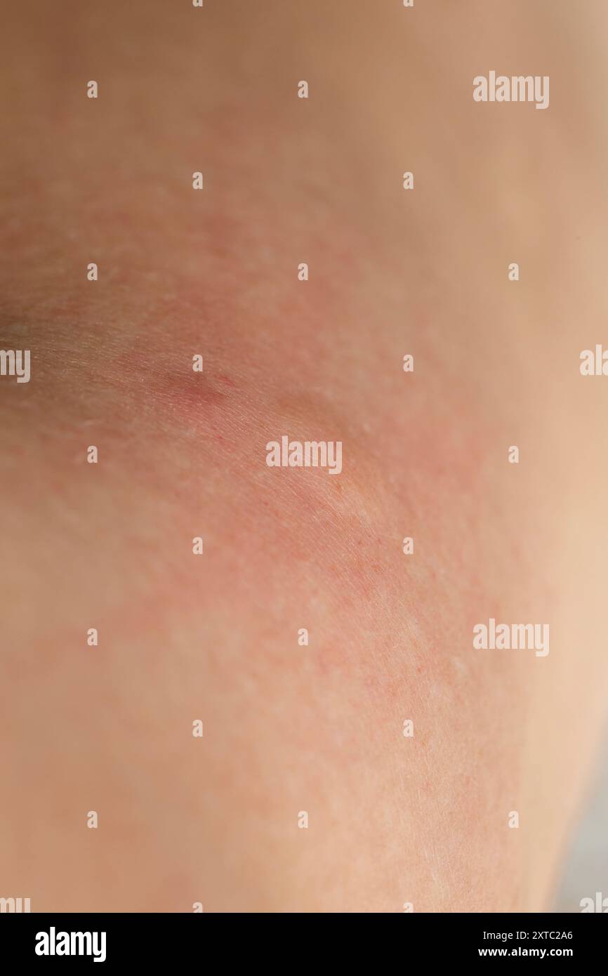 Inflamed human skin after a mosquito bite Stock Photo - Alamy