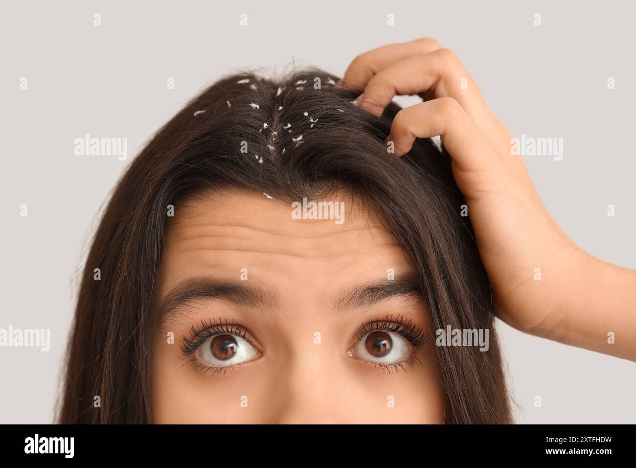 Young woman with dandruff problem on white background, closeup Stock ...