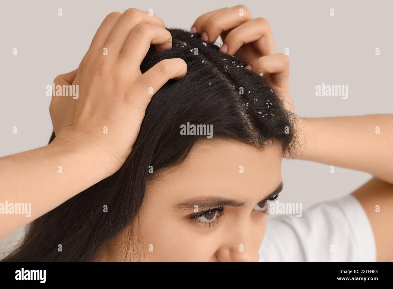 Stressed young woman with dandruff problem scratching head on white ...