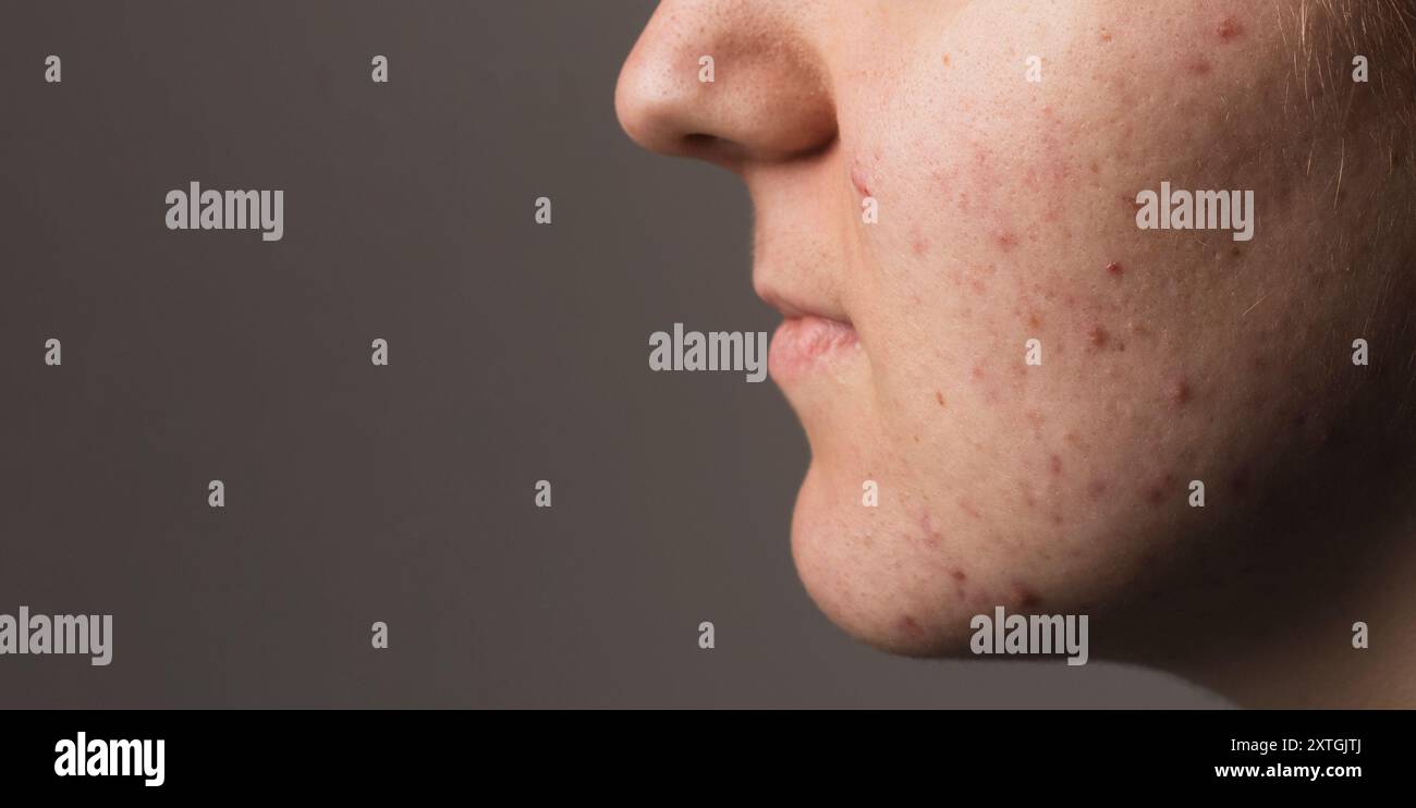 Pimple on face. Skin texture. Closeup acne skin. Treatment for skin ...