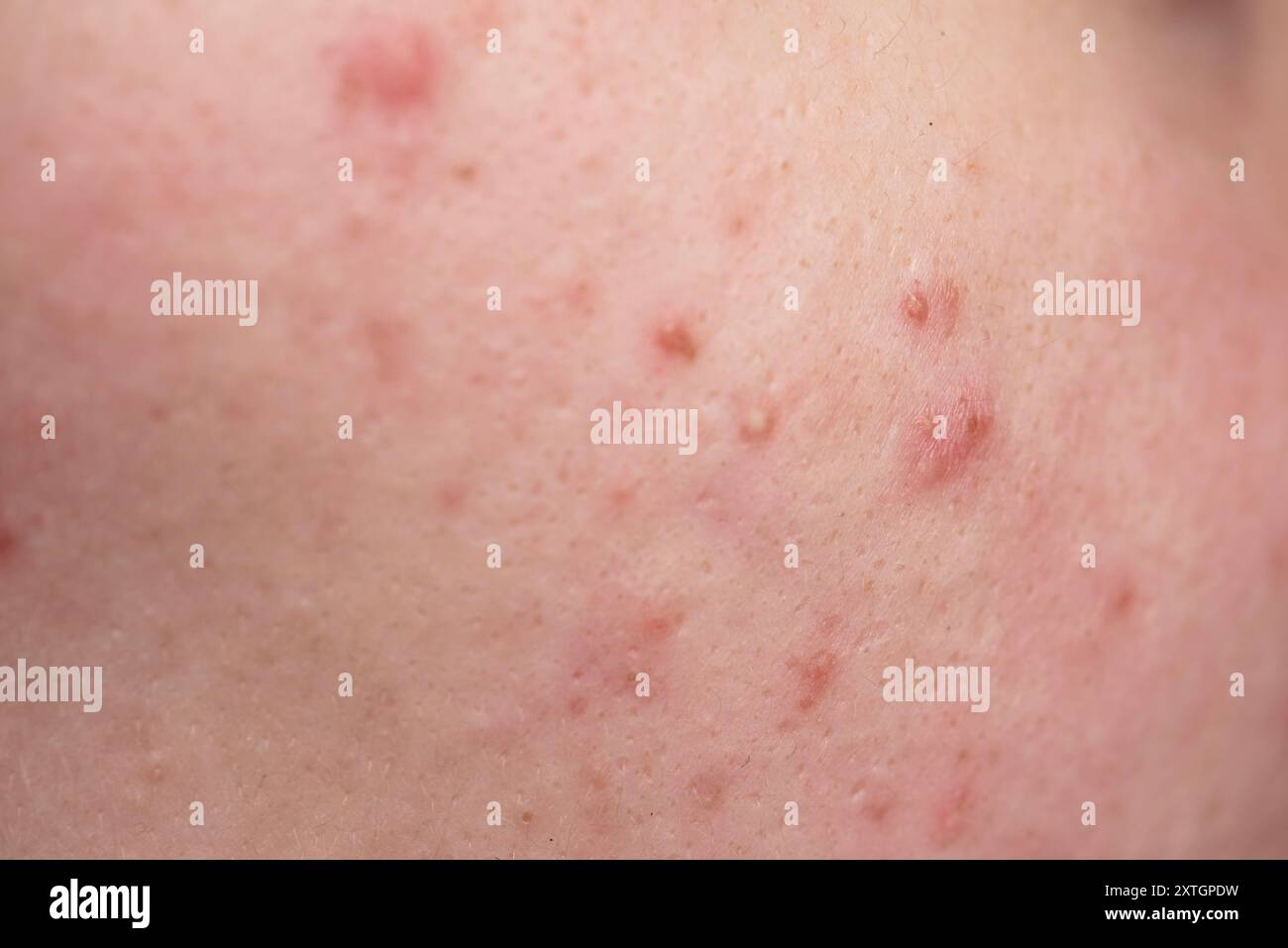 Skin acne background. Closeup acne pimple. Treatment for acne skin ...