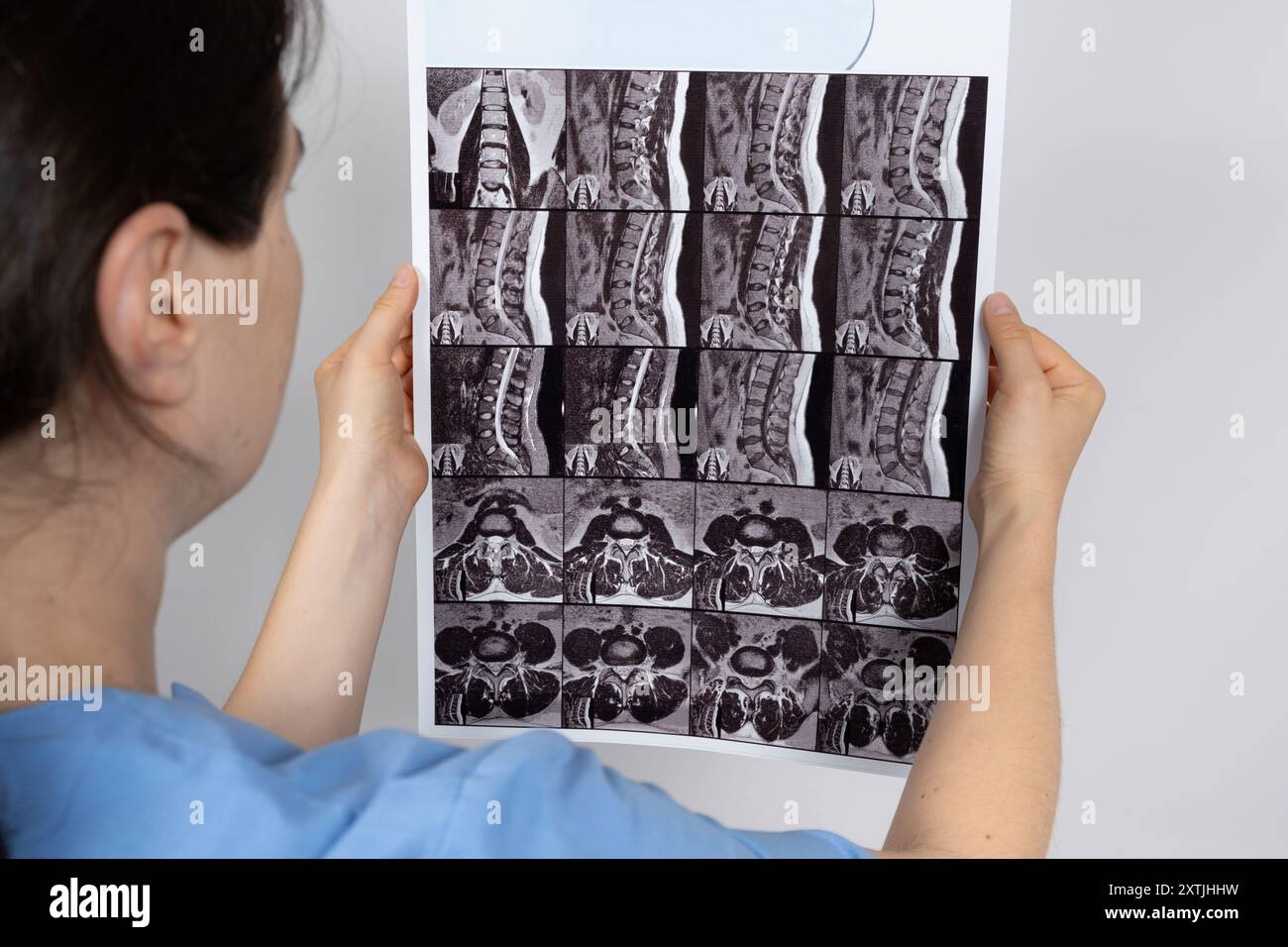 The doctor holds an MRI image of a patient with intervertebral disc ...