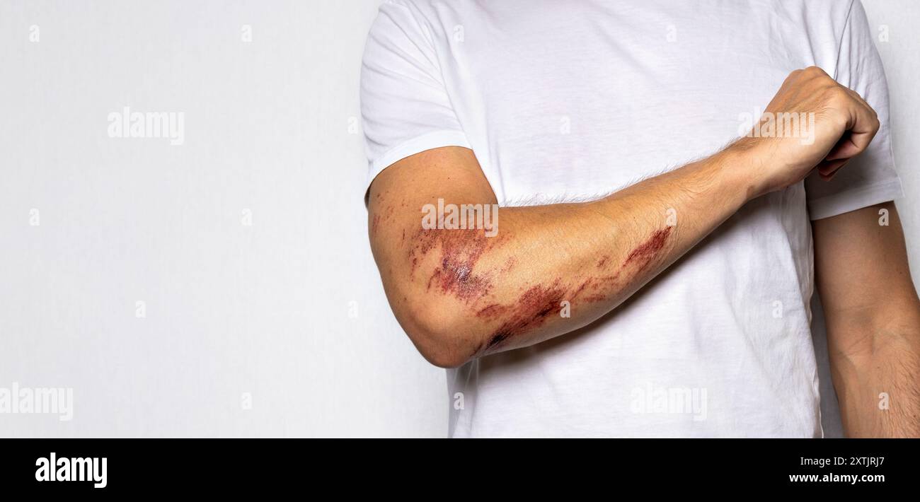 Handprint Bruise On Arm