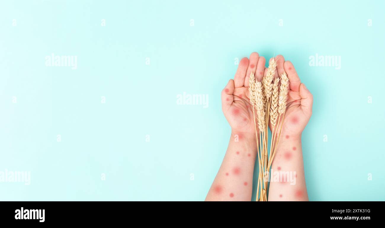 Gluten intolerance, celiac disease or wheat allergy, skin rash on the ...