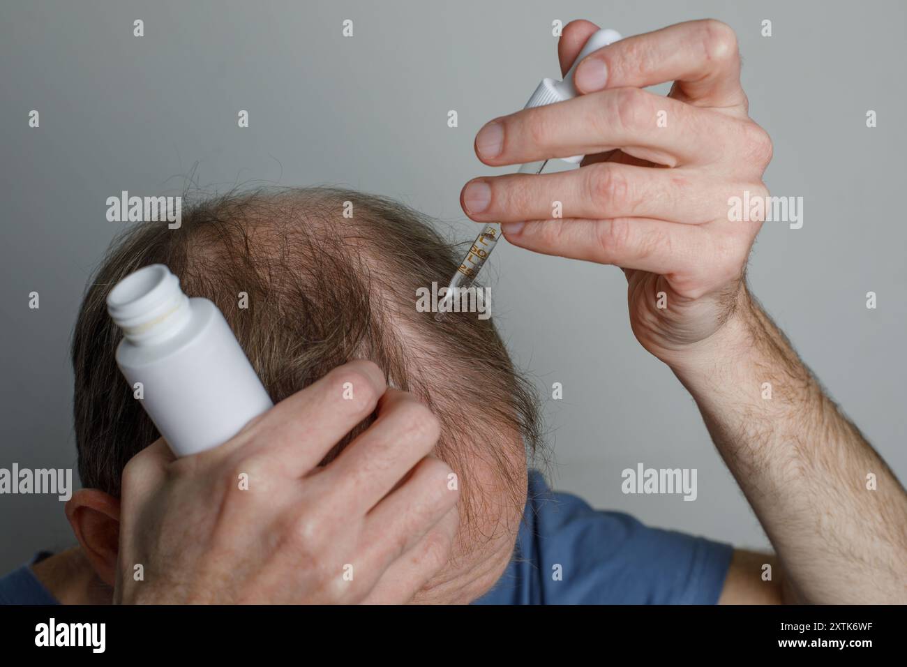 Male using hair serum or minoxidil or hair oil for the treatment of ...