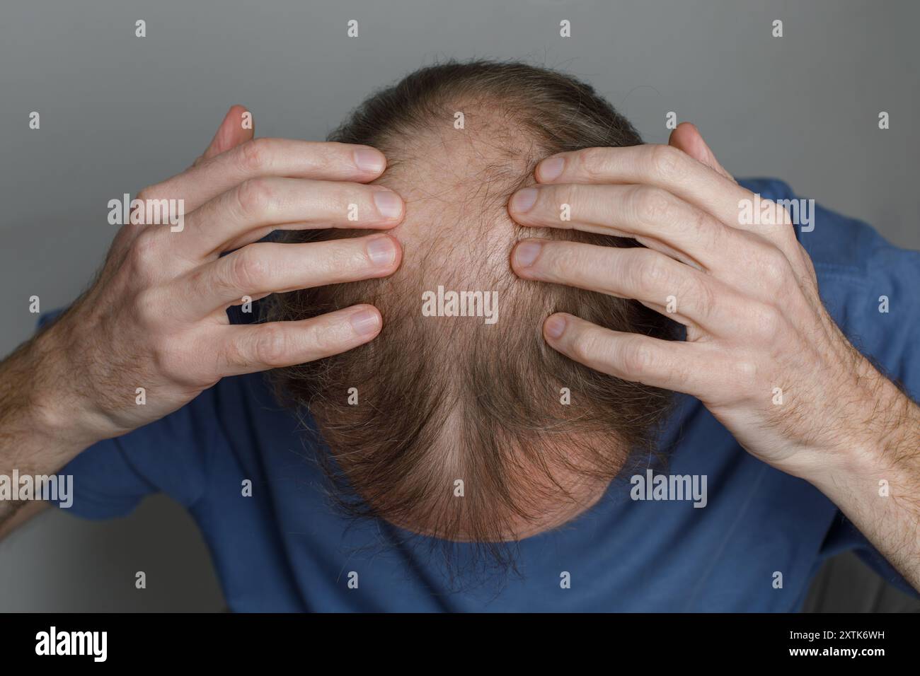 Close up human hair dandruff hi-res stock photography and images - Alamy