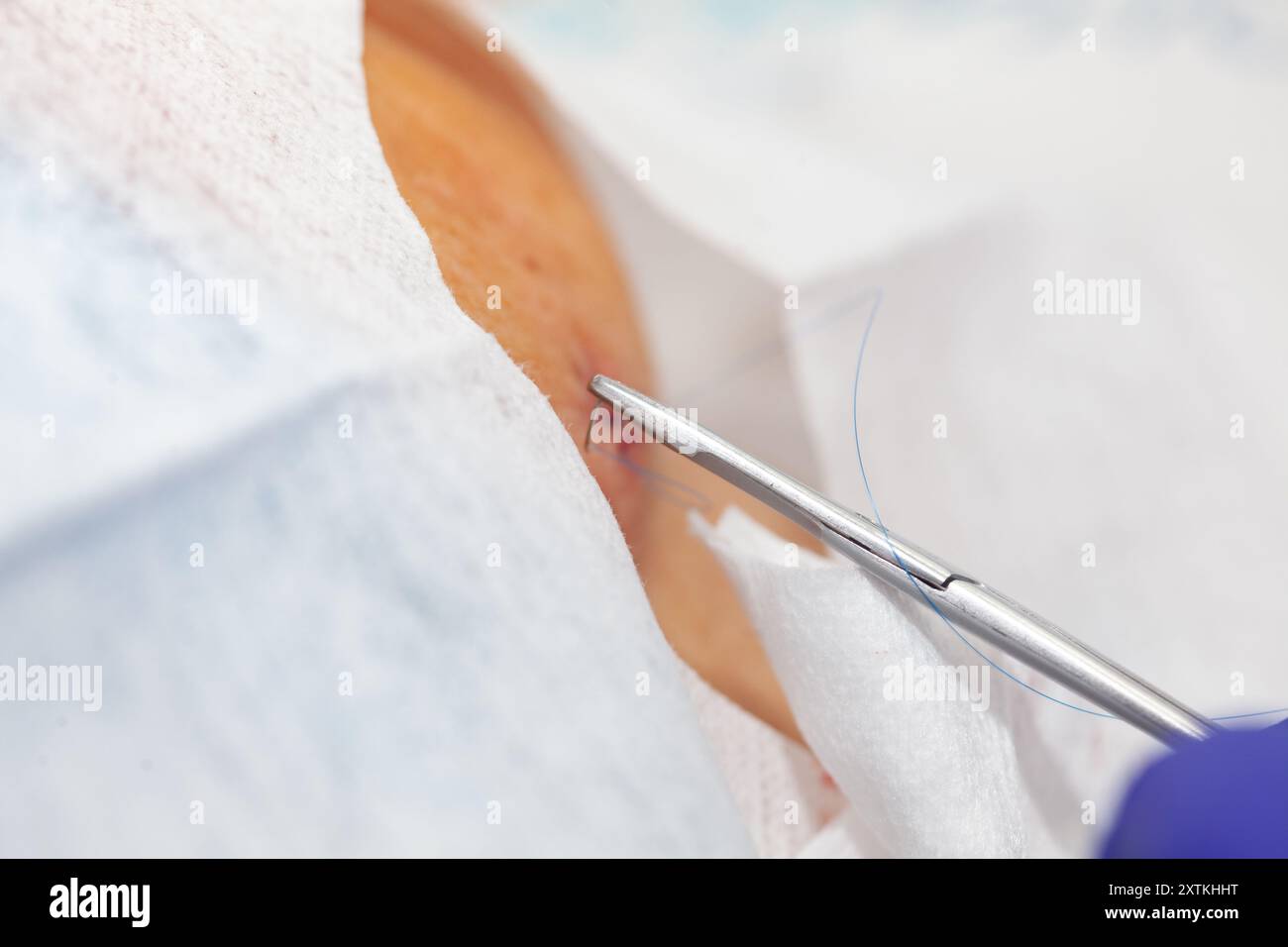 Dermatologist carrying out a skin biopsy on the face of a senior adult ...