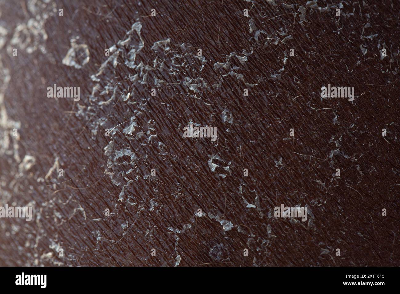 Flaky skin hi-res stock photography and images - Alamy