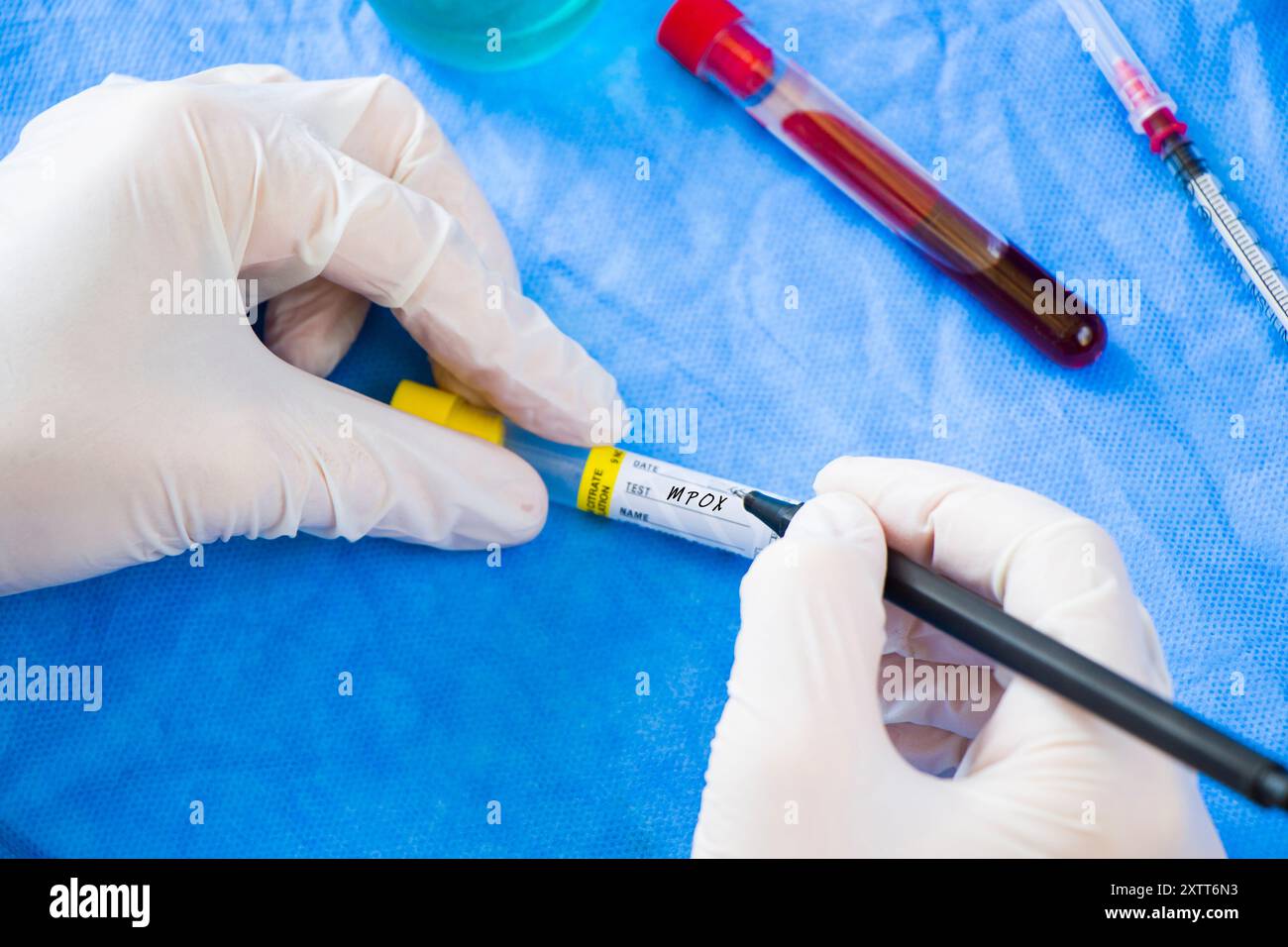 Mpox monkeypox virus, laboratory and blood test tube Stock Photo - Alamy