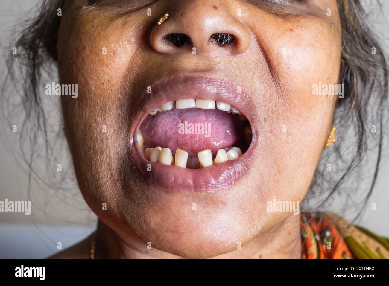 Close up of a woman's open mouth showing missing teeth. Dental problems ...