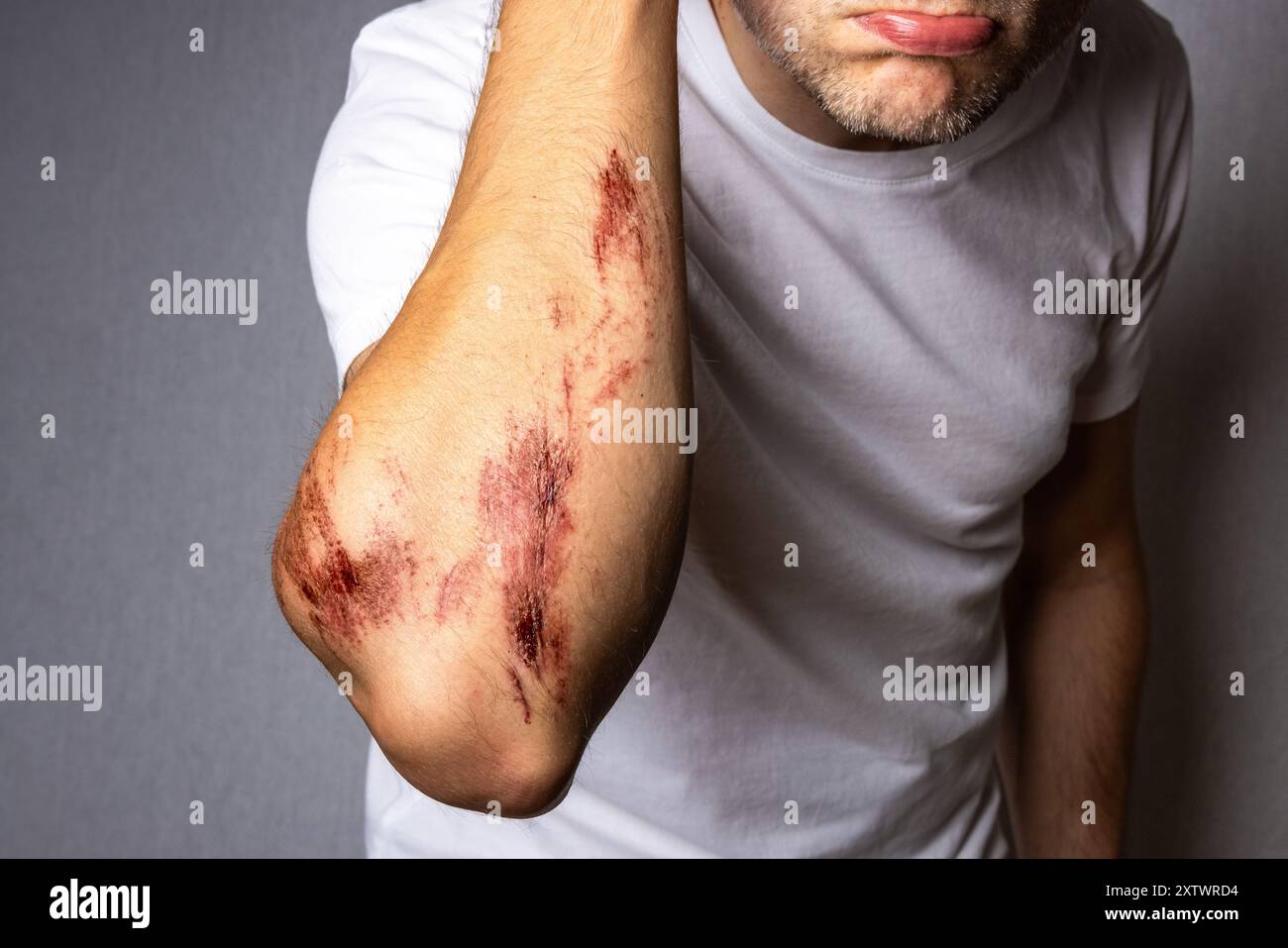 Arm abrasion accident hi-res stock photography and images - Alamy