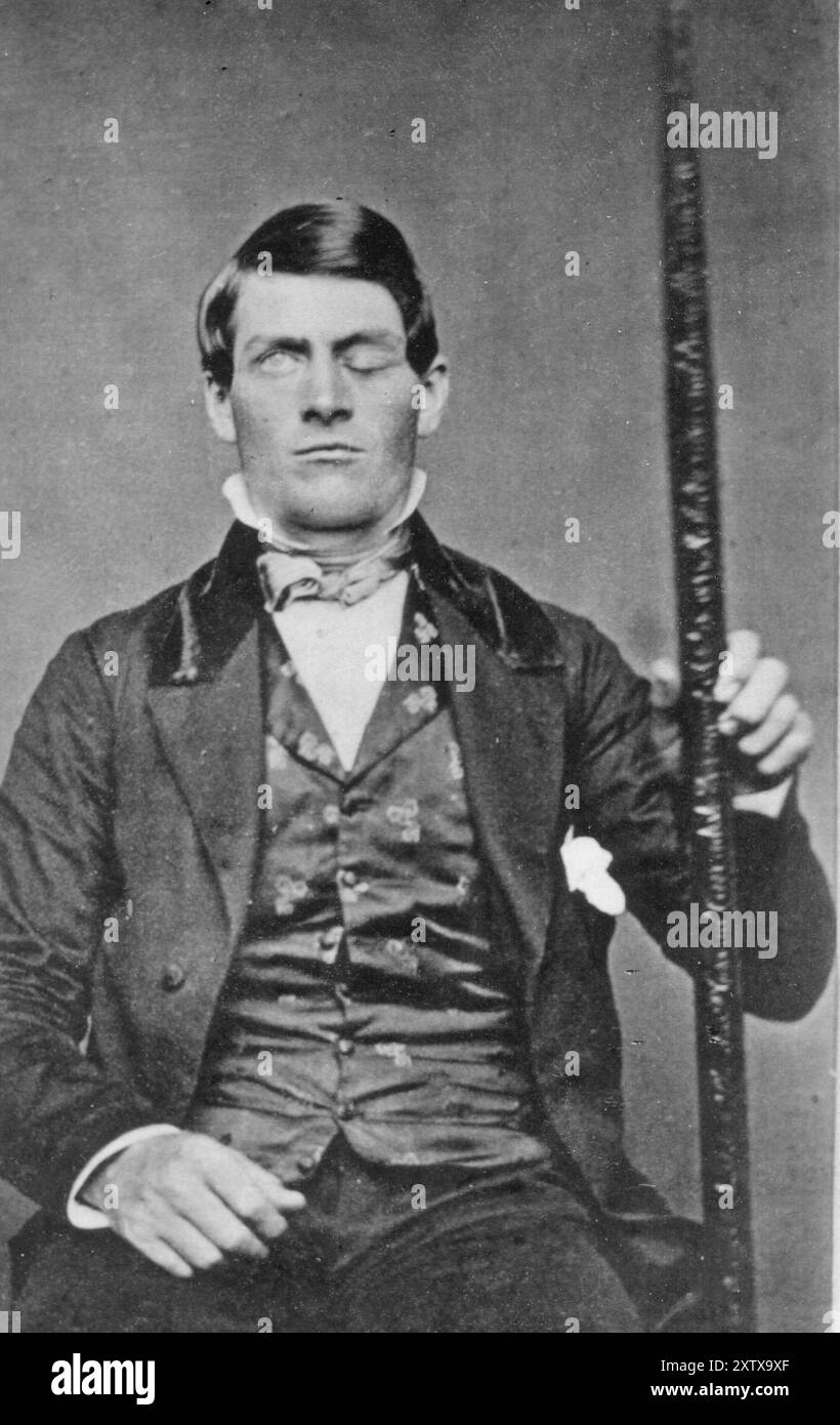 Phineas gage hi-res stock photography and images - Alamy