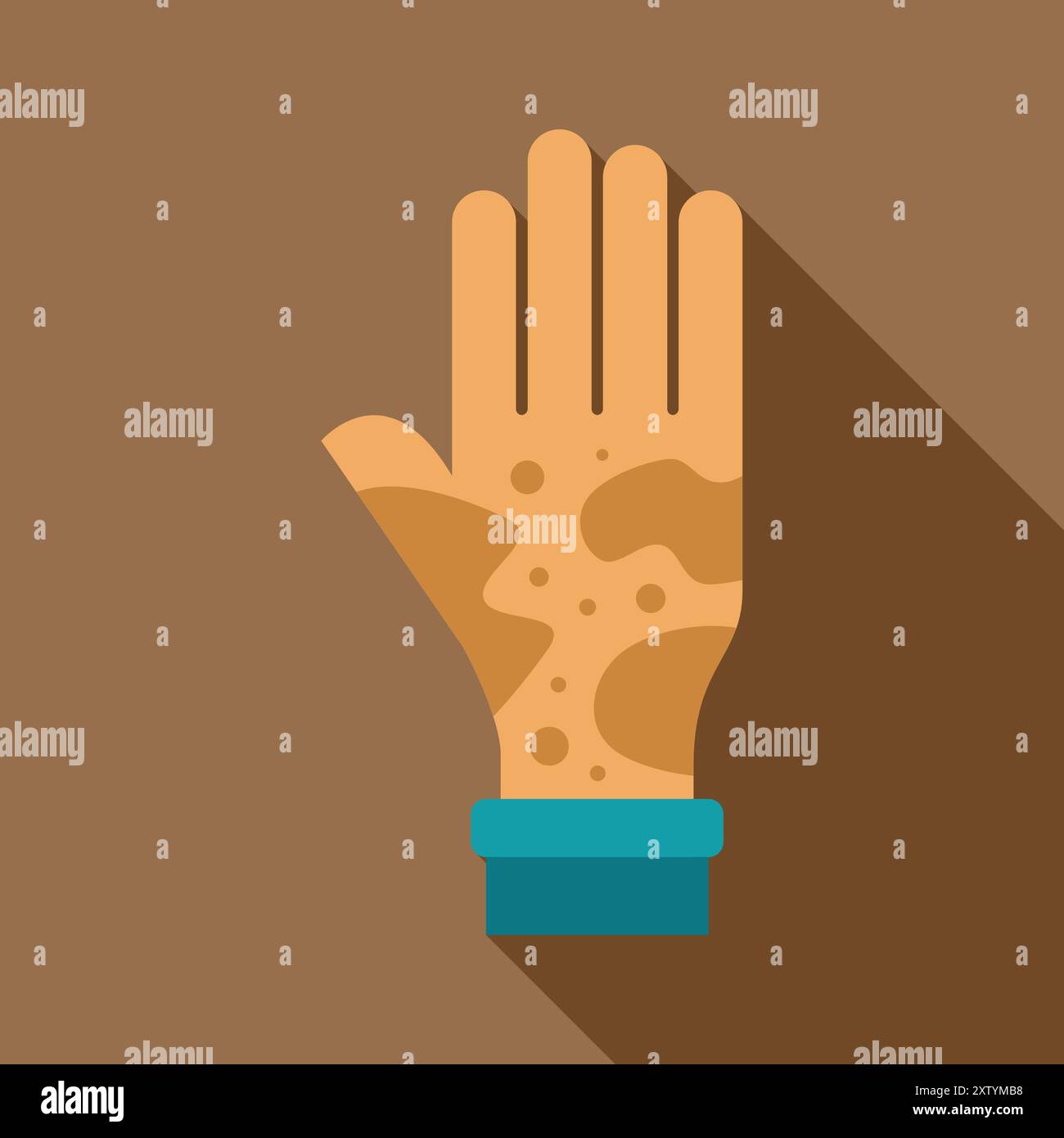 Close up of a hand with vitiligo, a long term condition where pale ...