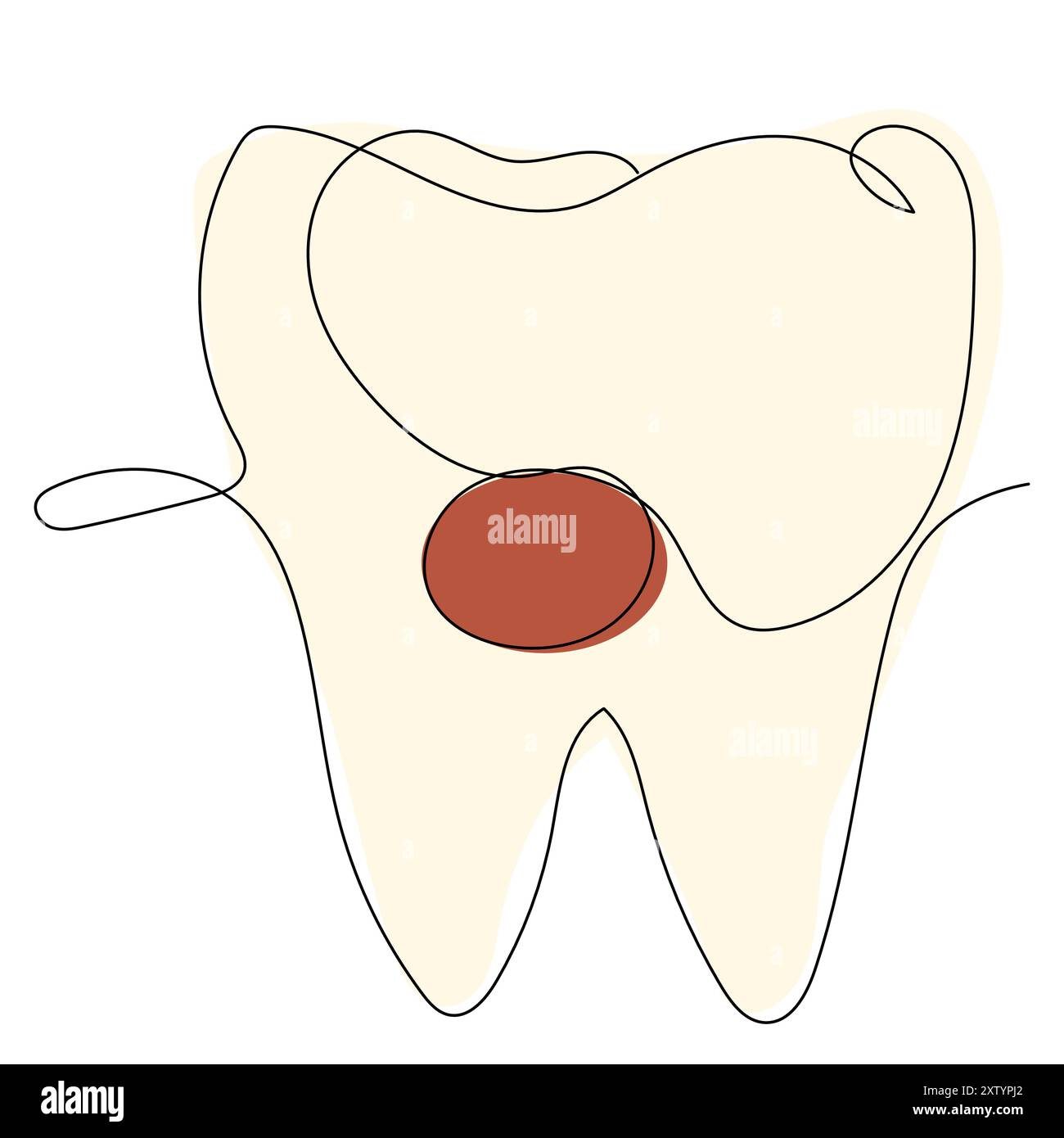 Simple Illustration of a Tooth With a Colored Cavity Highlighting ...
