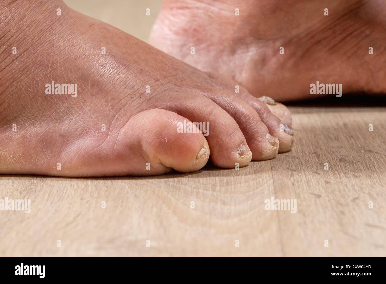 Cancer chemotherapy cause skin to become dry, dark or peel and nails ...